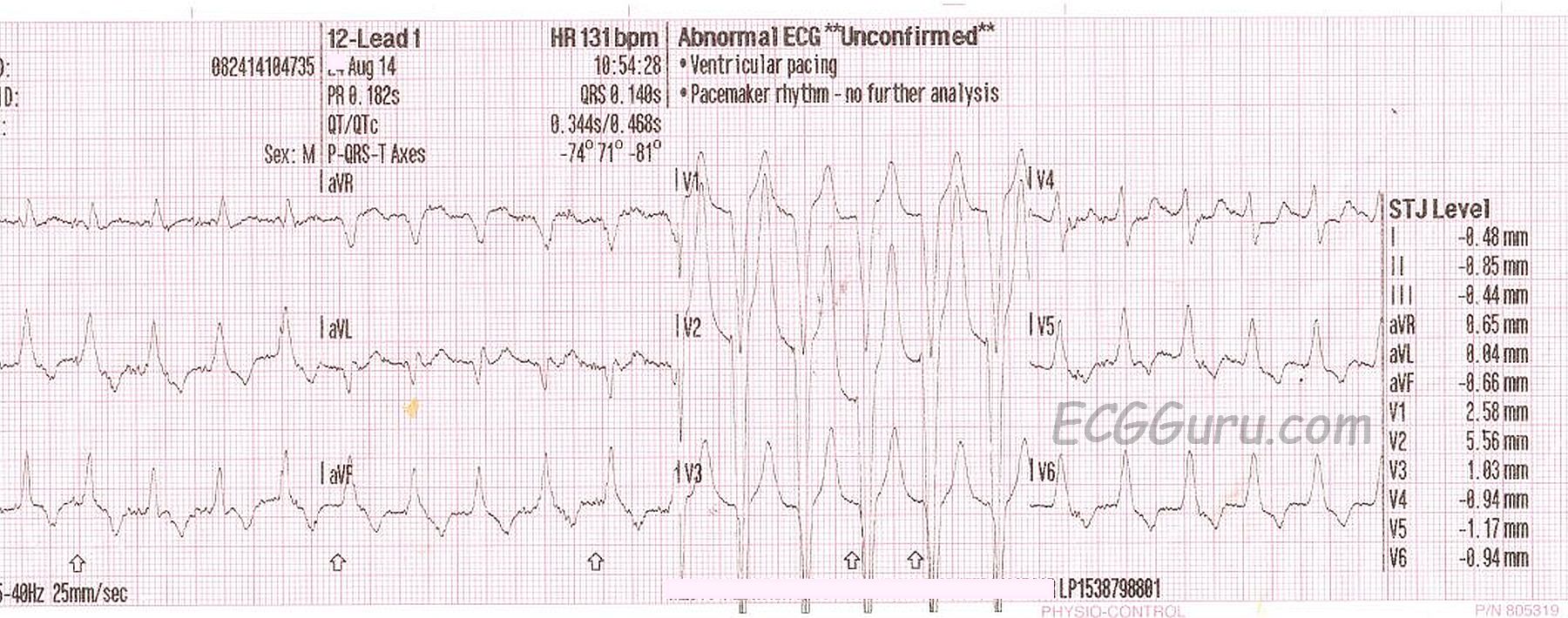 Wide Complex Tachycardia | ECG Guru - Instructor Resources Wide Complex Tachycardia | ECG Guru - Instructor Resources